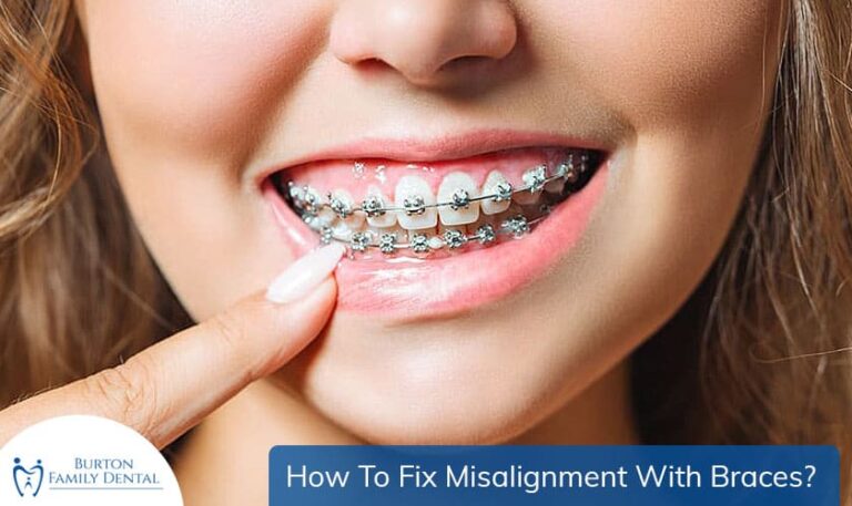 How To Fix Teeth Misalignment With Braces?